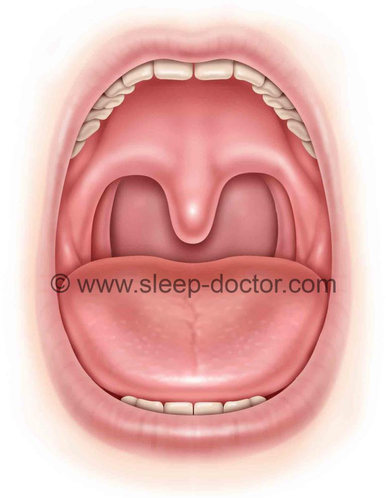 Palate surgery with small or absent tonsils: new research and a key to ...
