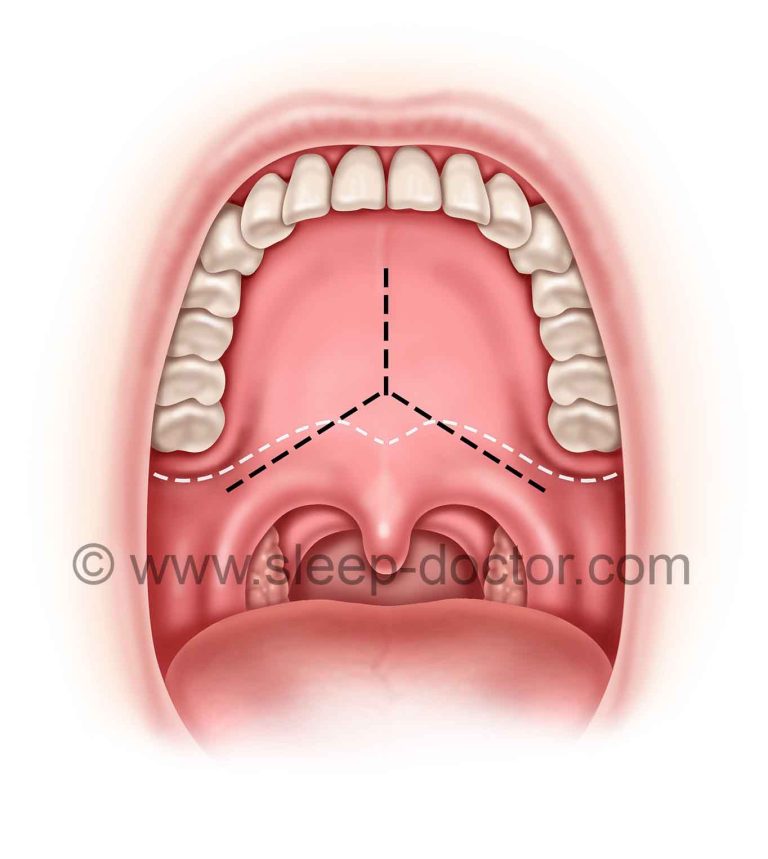 Palatal Advancement - Sleep Doctor