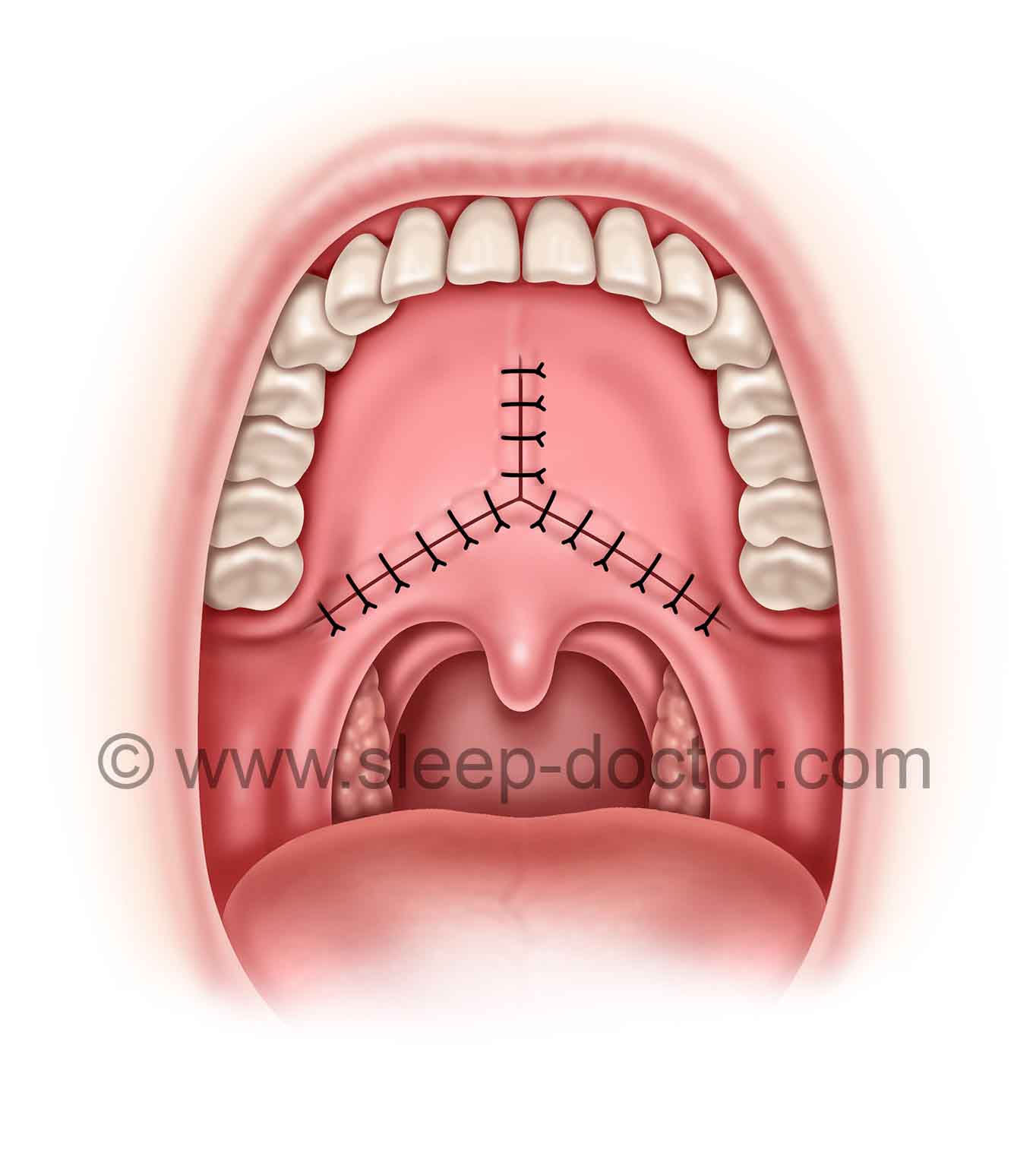 Palatal Advancement - Sleep Doctor