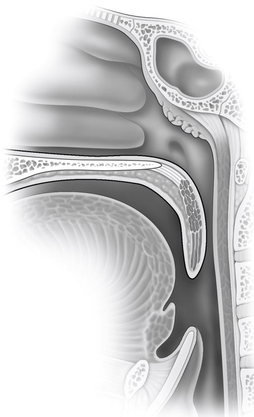 Palate shape is associated with Inspire Upper Airway Stimulation ... Palate shape is associated with Inspire Upper Airway Stimulation ...